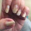 Onycholysis - NailKnowledge