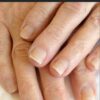 Nail Grooves / Depressions - NailKnowledge