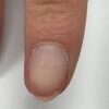 Nail Grooves / Depressions - NailKnowledge