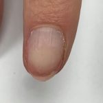 Nail Grooves / Depressions - NailKnowledge