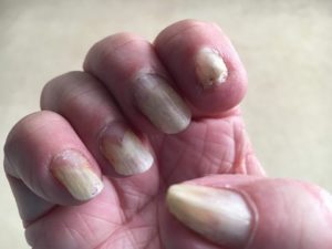 Onycholysis - NailKnowledge