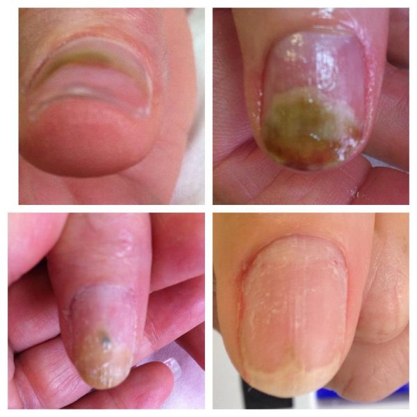 Chloronychia - NailKnowledge