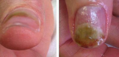 Chloronychia - NailKnowledge