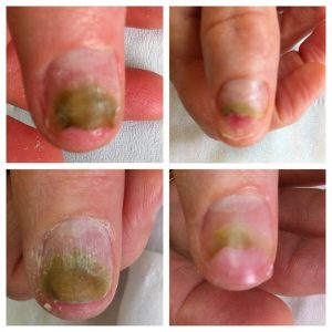 Chloronychia - NailKnowledge