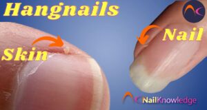 Hangnails - NailKnowledge