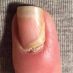 Onychomadesis - NailKnowledge