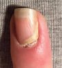 Onychomadesis - NailKnowledge