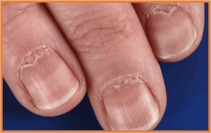 Onychomadesis - NailKnowledge