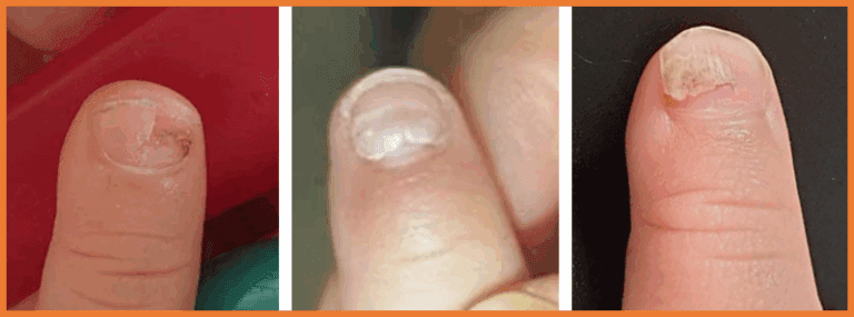 Onychomadesis - NailKnowledge