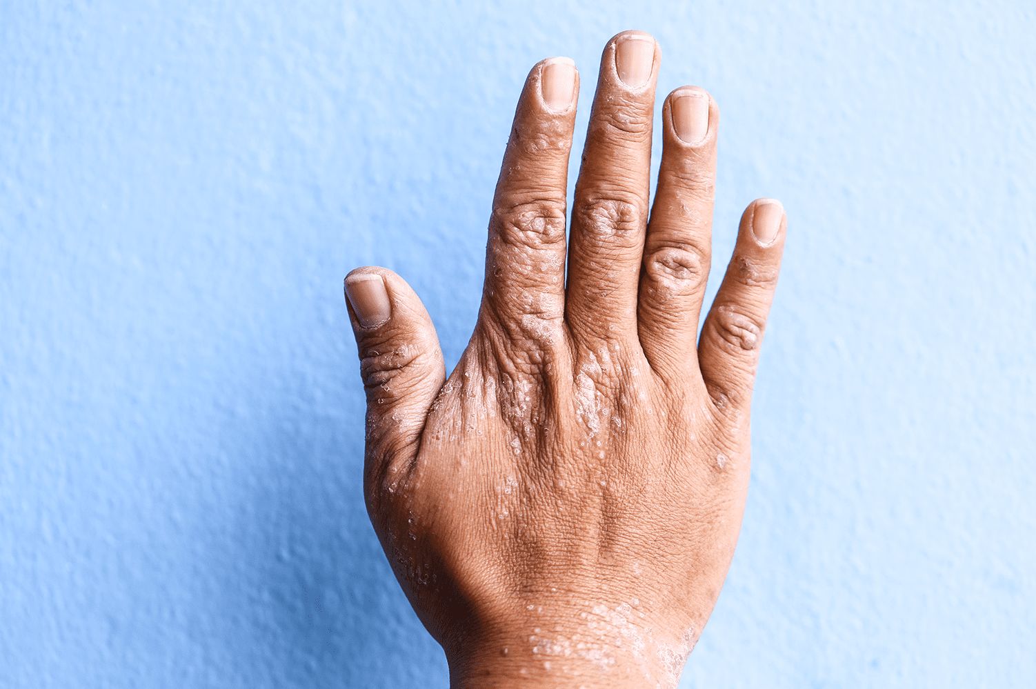 Dermatitis - NailKnowledge