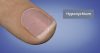 Hyponychium - NailKnowledge