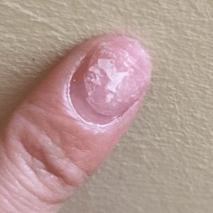 Introduction to Nail Conditions - NailKnowledge
