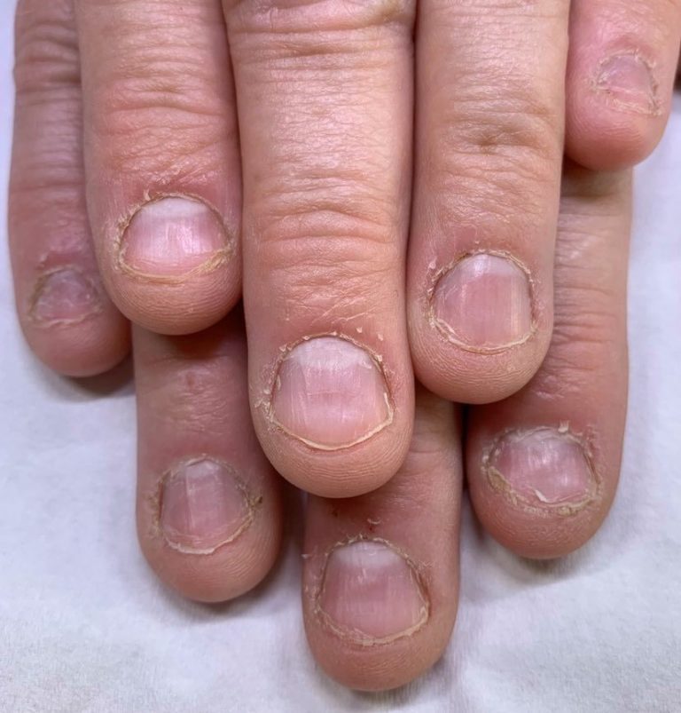 Onychophagia - NailKnowledge