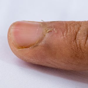 Hangnails - NailKnowledge