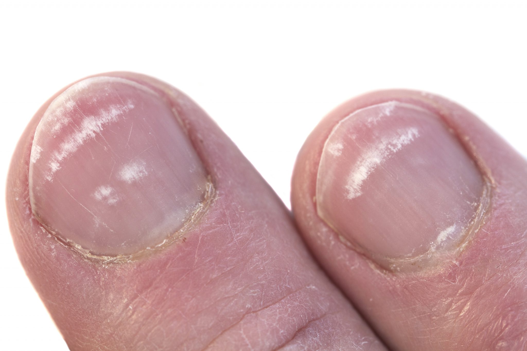 Nail Plate Calcium Deficiency: What White Spots Really Mean - NailKnowledge