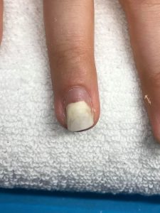 Onycholysis - NailKnowledge