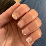 Onycholysis - NailKnowledge