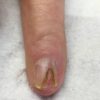 Chloronychia - NailKnowledge