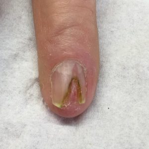 Chloronychia - NailKnowledge