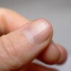 Nail Grooves / Depressions - NailKnowledge