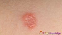 Dermatophyte and non-dermatophyte fungi - NailKnowledge