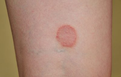 Dermatophyte and non-dermatophyte fungi - NailKnowledge