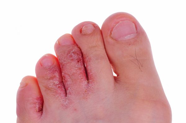 Dermatophyte and non-dermatophyte fungi - NailKnowledge