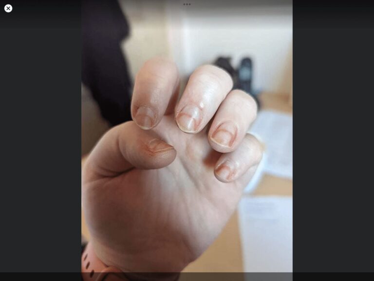 COVID-19 Nail Disorders - NailKnowledge