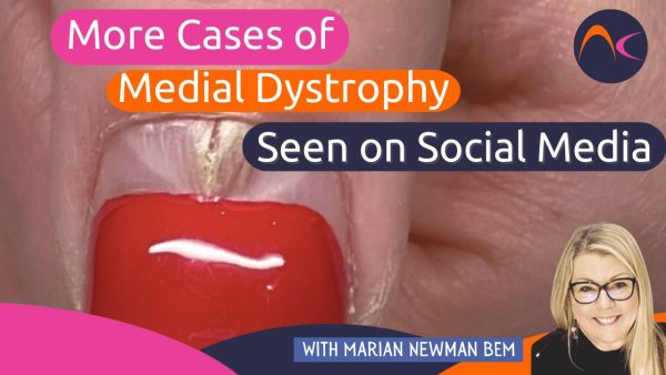 Medial Nail Dystrophy - NailKnowledge