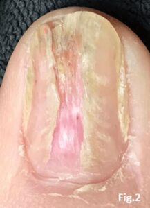 Brittle Nails: Causes, Prevention, and Treatment - NailKnowledge