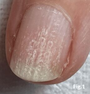 Brittle Nails: Causes, Prevention, and Treatment - NailKnowledge