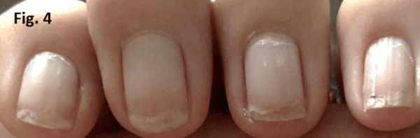 Unhas quebradiças: Causas, prevenção e tratamento - NailKnowledge