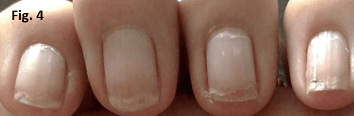 Brittle Nails: Causes, Prevention, and Treatment - NailKnowledge