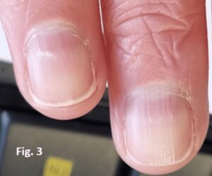 Brittle Nails: Causes, Prevention, and Treatment - NailKnowledge