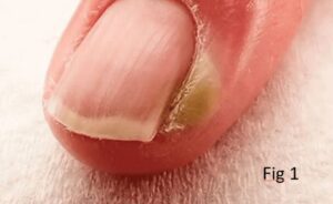 Paronychia - NailKnowledge