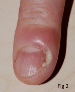 Paronychia - NailKnowledge