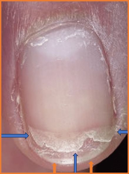 Peeling Nails: Unveiling the Culprits Behind Flaking and Peeling ...