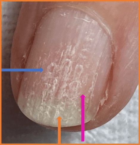 Peeling Nails: Unveiling the Culprits Behind Flaking and Peeling ...