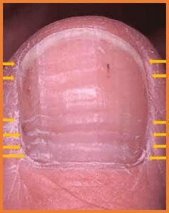 Beau's Lines - NailKnowledge