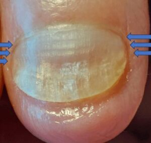 Beau's Lines - NailKnowledge