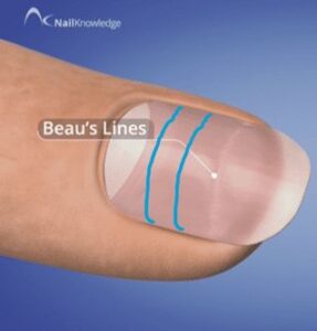 Beau's Lines - NailKnowledge