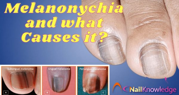 Melanonychia - NailKnowledge