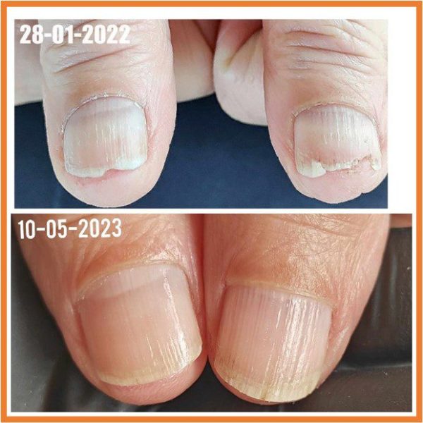 The Science Behind Dry and Split Nail Plates in Detail - NailKnowledge