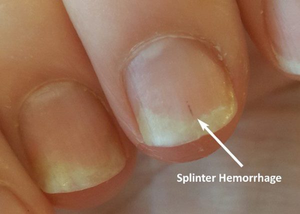 Clarifying the Rumour about Monomer Hallucinations