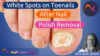 White Spots on Toenails After Nail Polish Removal - NailKnowledge