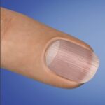 Understanding Onychorrhexis and Its Impact on Nail Health - NailKnowledge
