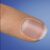 Understanding Onychorrhexis and Its Impact on Nail Health - NailKnowledge