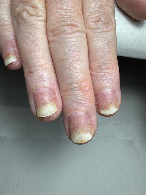 Can Onycholysis be a sign of Thyroid Disorders? - NailKnowledge