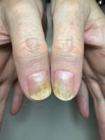 Can Onycholysis be a sign of Thyroid Disorders? - NailKnowledge