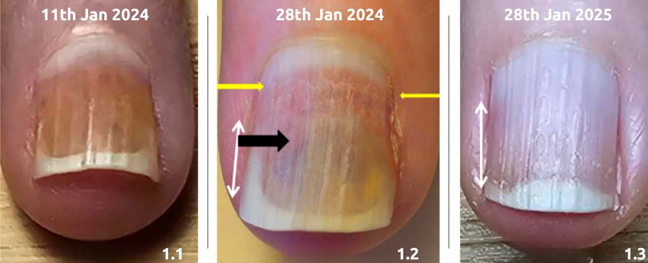 Gel Polish After Chemotherapy - NailKnowledge